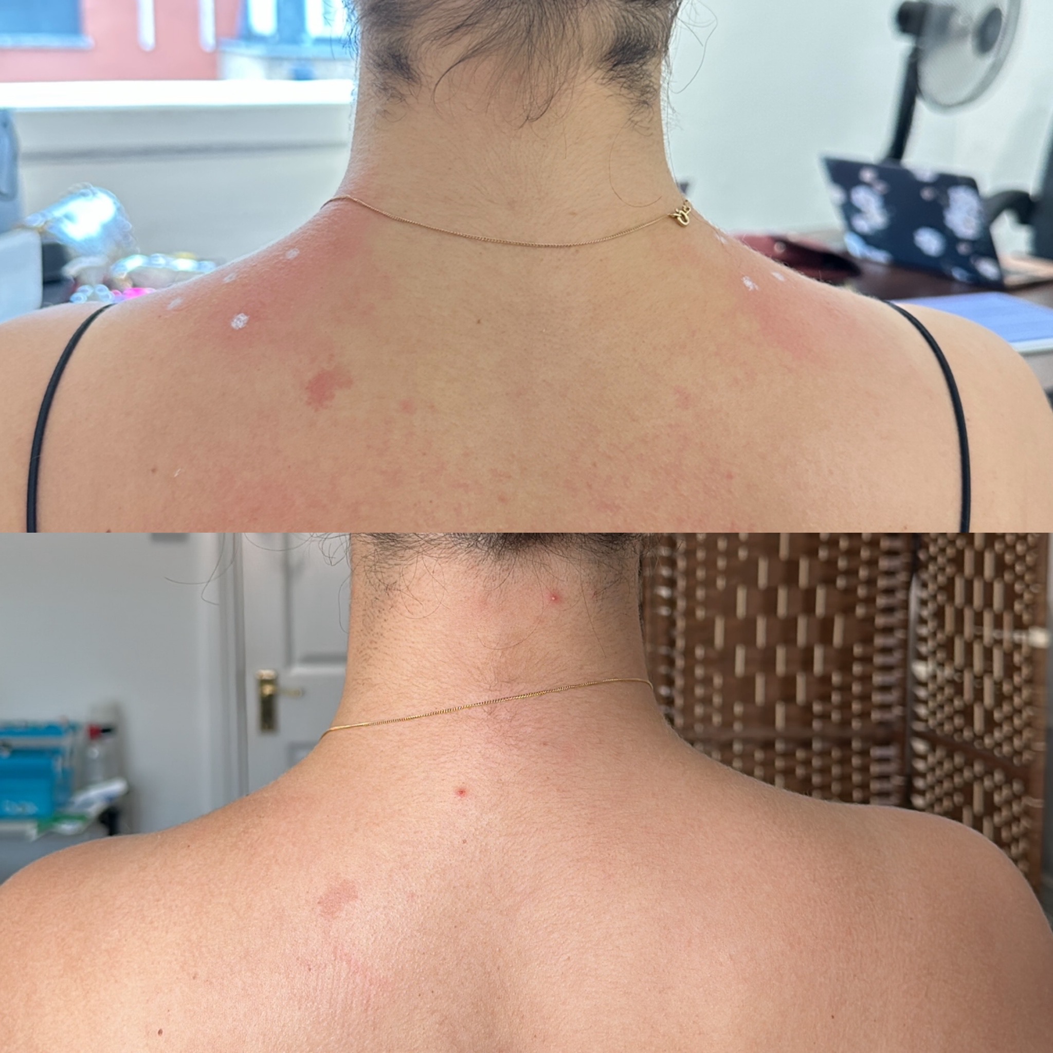Botulinum Toxin Treatment for Trapezius Muscle and Migraines - Harmony ...