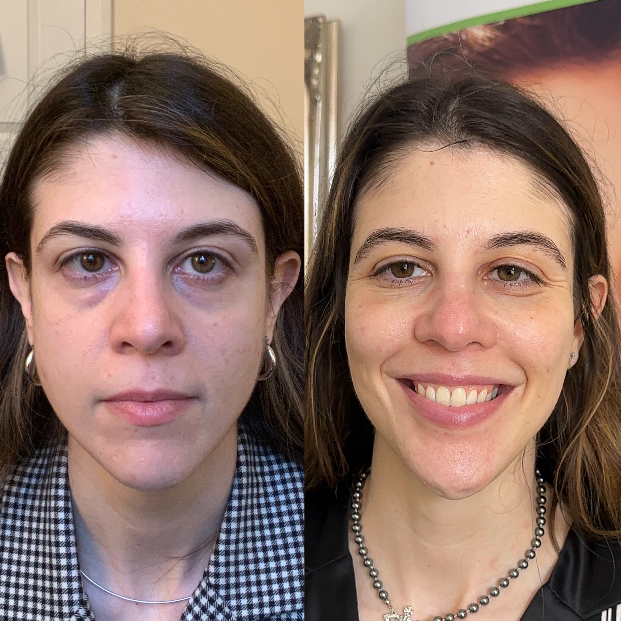 Ellanse Bioremodulating Filler - Harmony Medical Aesthetics | Cosmetic ...